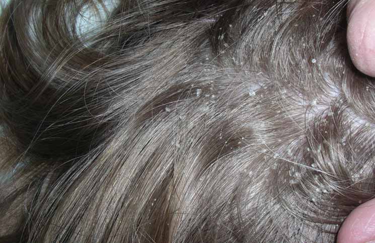 16 Home Remedies to Get Rid of Dandruff in a Quick, Safe, and Effective ... 16 Home Remedies to Get Rid of Dandruff in a Quick, Safe, and Effective ...